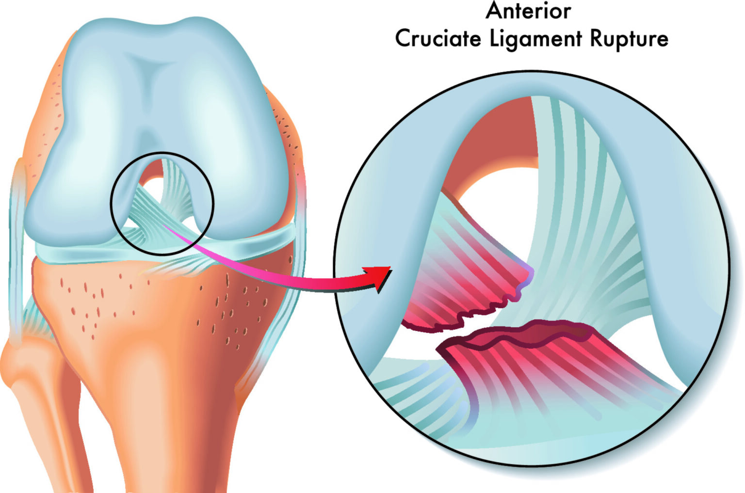 ACL Rupture - Orthopaedic Medical Group of Tampa Bay